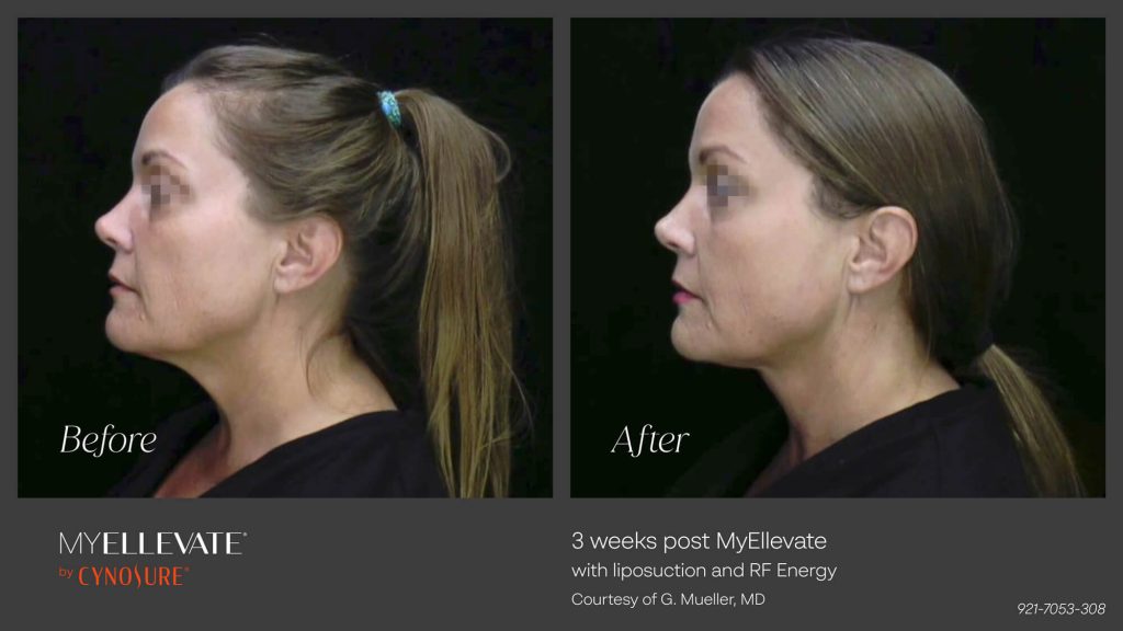 MyEllevate | Non-Surgical Neck Lift In Scottsdale, AZ